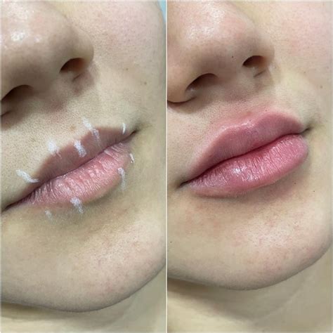 Preenchimento Labial Antes E Depois