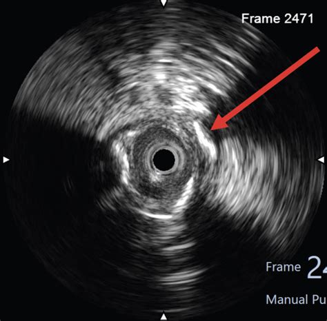 Deep Femoral Artery Ultrasound