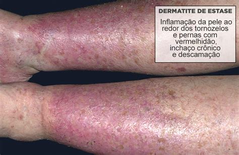 Flebite o que é sintomas tratamentos e riscos para a saúde