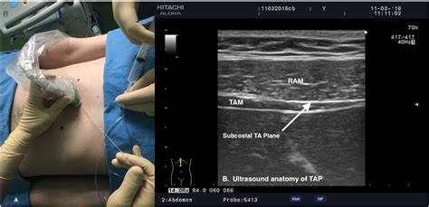 Transversus Abdominis Plane Block