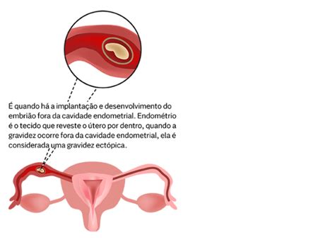 Gravidez ectópica o que é sintomas causas e tratamento Nav