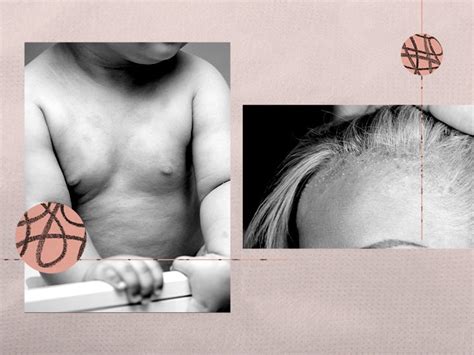 Eczema Images Types Body Parts And More