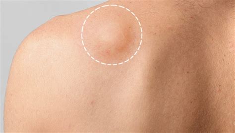 Retirada De Cistos E Lipomas Biot Dermatologia