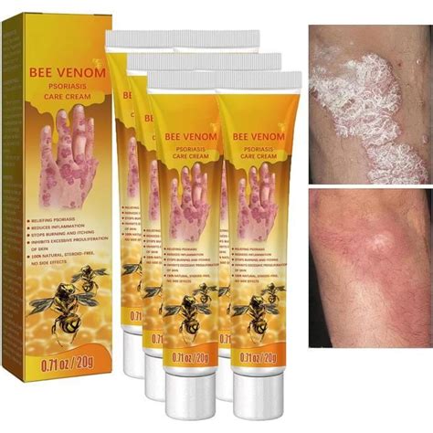 Venin d abeille Professionnel Psoriasis Traitement crème apaisant