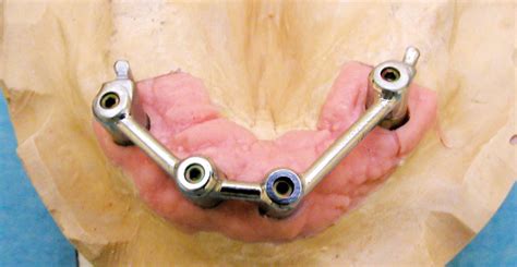 La prothèse amovible complète maxillaire stabilisée sur implants L
