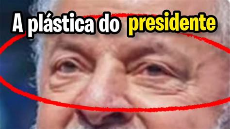 O LULA FEZ CIRURGIA PLÁSTICA DE PÁLPEBRAS BLEFAROPLASTIA