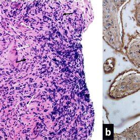 Photomicrographs Of Resected Specimen A Hematoxylin And Eosin Staining