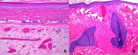 Histopathologic Features Of The Epidermoid And Dermoid Cysts Removed Download Scientific