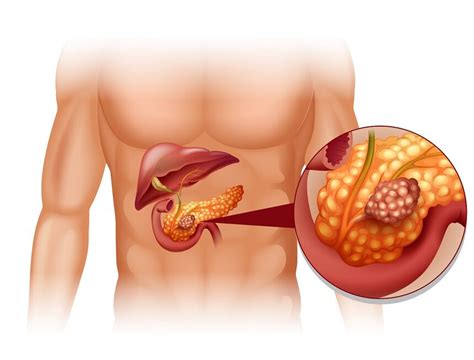 Rak Trzustki Diagnoza Objawy Leczenie Czynniki Ryzyka Zdrowie