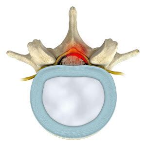 Epidural Steroid Injections Chicago Pars Defect Injections Bursa