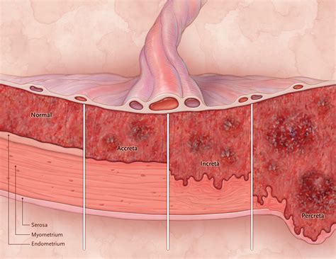 Placenta Accreta Part I Pathophysiology Diagnosis And Imaging