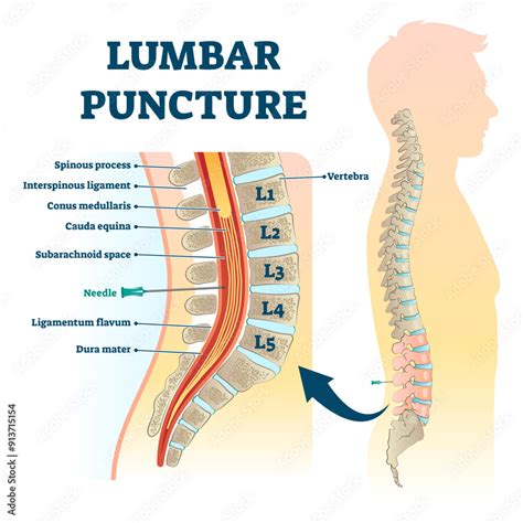 Lumbar Puncture Illustration Transparent Background Labeled Spinal