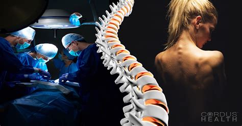 90 de cirugías por hernias discales se pueden evitar Cordus España