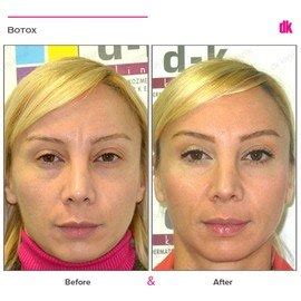 Botox Frown Lines Before And After Gallery