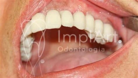 Protese Metaloceramica Sem Gengiva Arcada Completa 50kb ImplArt
