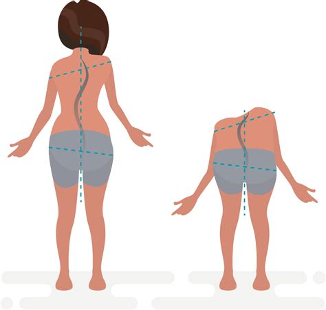 La Escoliosis La Columna Vertebral Soporte Para La Espalda Imagen Png