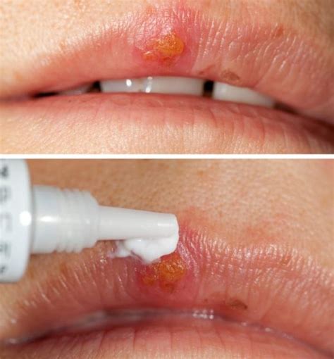 Herpes labial contagio síntomas y tratamiento