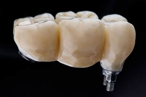 Síntomas de rechazo de un implante dental