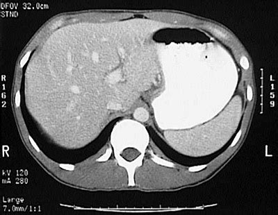 Clinical Cases Duodenum Pancreas Liver Gallbladder 106500 Hot Sex Picture