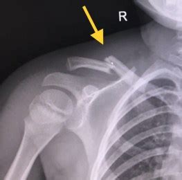 Fractura de clavícula Lo que debes saber de la fractura de los