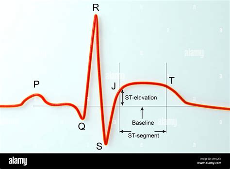 Elektrokardiogramm EKG während ein Myokardinfarkt Herzinfarkt