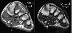 Plantar Fibromatosis Radiology Cases