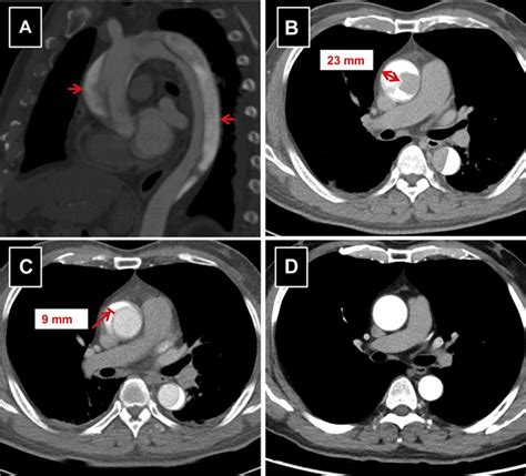 Spontaneous Resolution Of Iatrogenic Aortic Dissection After Coronary