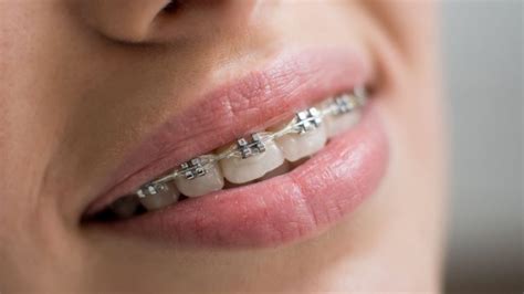 Tipos de aparelho dentário descubra o certo pra você Clinica OralDents