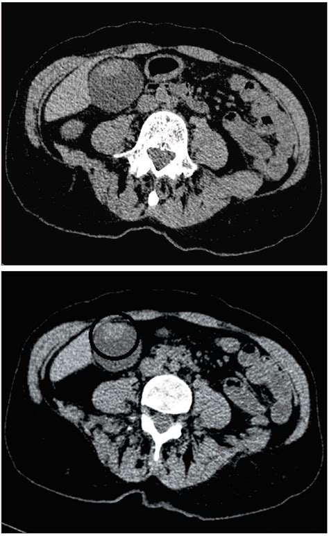 Neoplasia papilar intracolecística rara patologíade la vesícula biliar