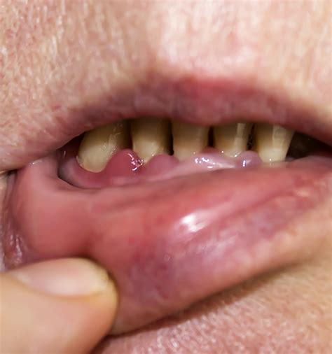 Periodontitis Causes Symptoms And Treatment Chinook Dental Group