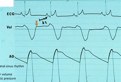 Vm Cardiovascular System Phonocardiography Flashcards Quizlet