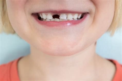 Mi hijo se ha roto un diente Qué debo hacer Clinica Dental Casablanca