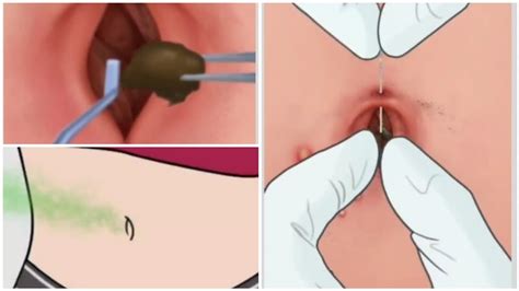 ASMR Remove Huge Navel Stone Animation By Ksenia Removehugenavel