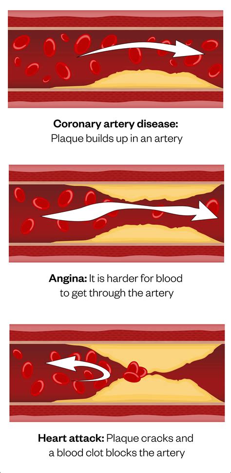Diagnosis And Management Of Stable Angina The Pharmaceutical Journal