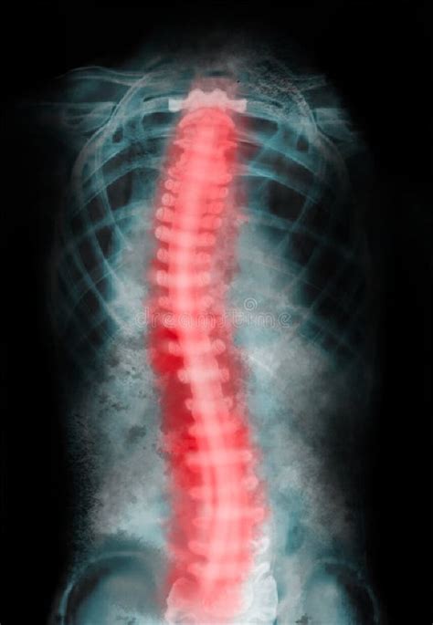 Xray De La Columna Vertebral Humana Con Curvatura Pacientes Con
