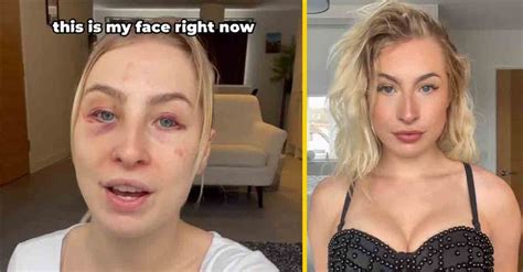 19 Disturbing Times People Took Plastic Surgery Too Far Plastic
