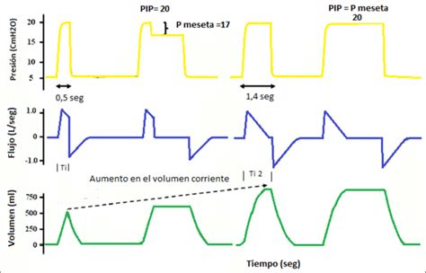 VENTILACIÓN CONTROLADA POR VOLUMEN VS PRESIÓN PDF Download Available