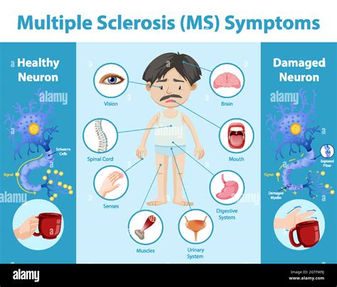 Multiple Sclerosis MS Symptoms Information Infographic Stock Vector