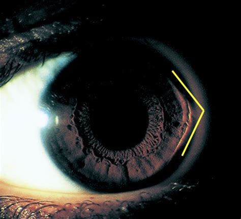 Non Inflammatory Corneal Ectasias Flashcards Quizlet