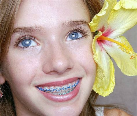 Purple Braces Color Teeth Braces Ideas Teeth Braces Cute Braces