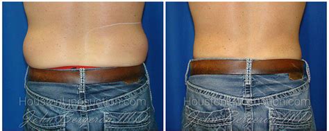 Love Handle Liposuction Smartlipo In Houston TX