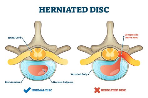 What Is A Slipped Disc In Lower Back At Kerry Kerns Blog