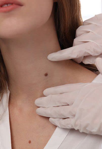 Mole Removal Treatment In Bharatpur Mole Removal Cost In Bharatpur