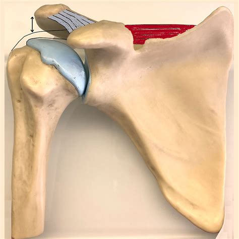 Traitement du conflit sous acromial à Versailles Chirurgie de l
