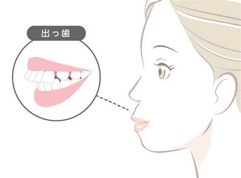 歯列矯正で顔は変わる出っ歯や受け口しゃくれの影響と変化パターンを紹介 椿クリニック審美矯正歯科公式