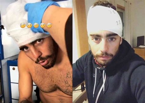 Pedro Scooby sofre acidente e posta imagem forte da cabeça pontos