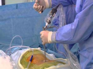 Cirurgia Endosc Pica De Coluna O Que E Suas Vantagens