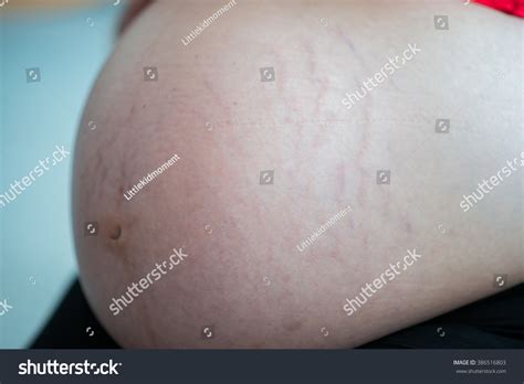 Pregnancy Belly Stretch Marks Skin Close Up Stock Photo