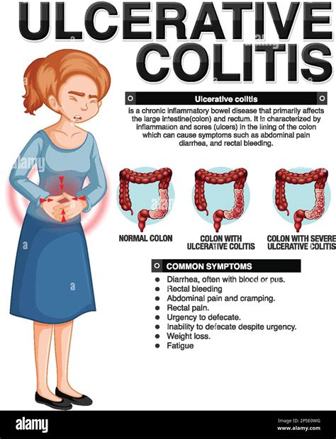 Ulcerative Colitis Causes Symptoms Diagnosis And Treatment