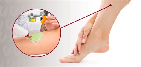 Laser Transd Rmico No Tratamento De Vasinhos E Varizes
